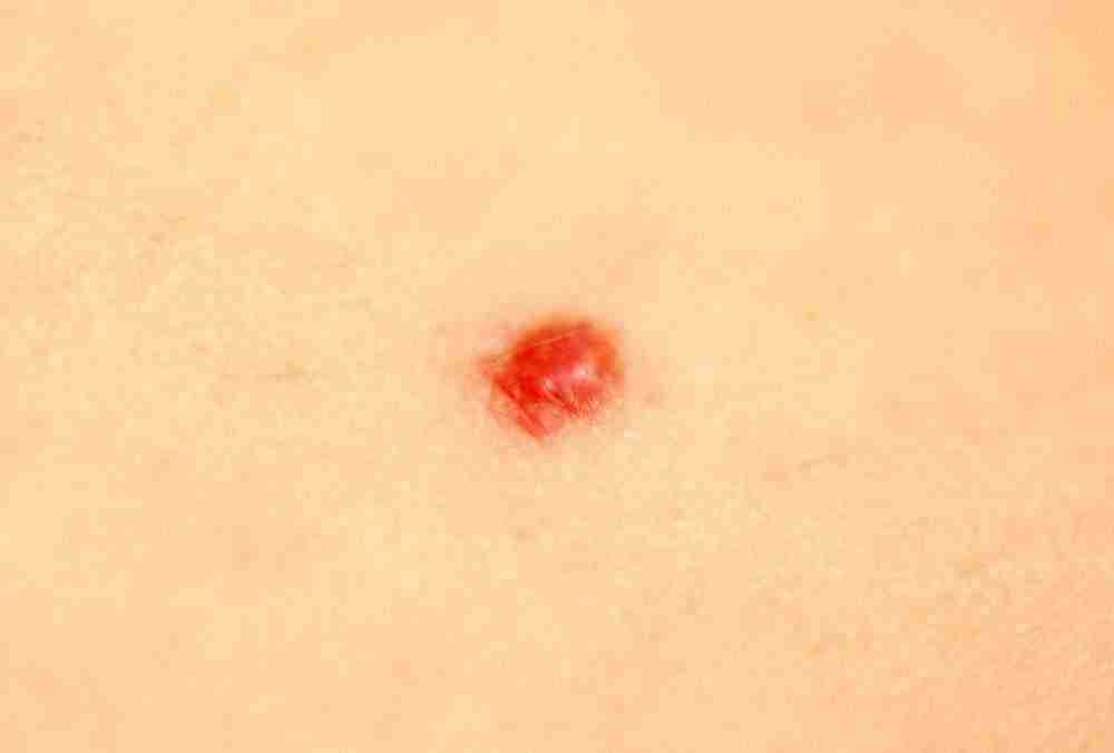 ¿Sabes lo que significan estos puntos rojos de la piel?