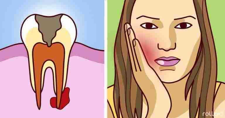 Síntomas de un absceso dental y cómo tratarlo en caso de emergencia