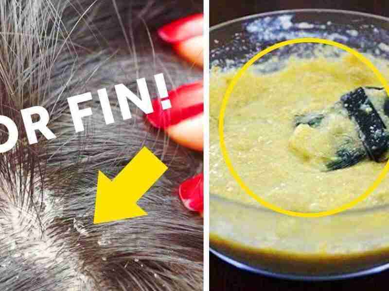 Los mejores remedios naturales para eliminar la caspa