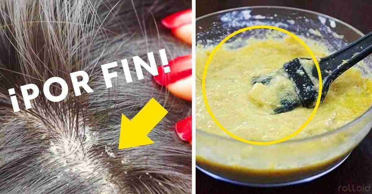 Los mejores remedios naturales para eliminar la caspa